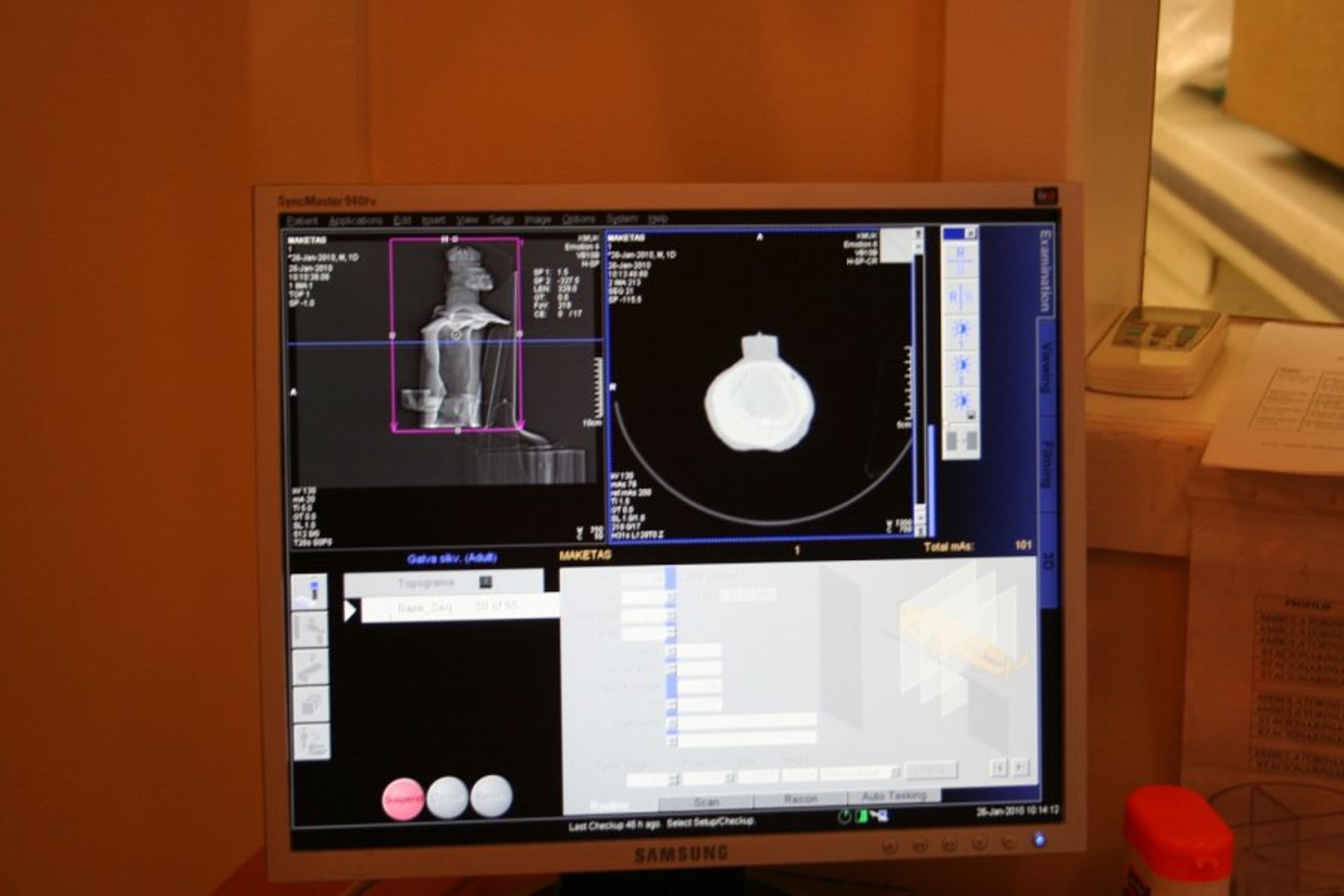 Kompiuterinė tomografija didina vaikams leukemijos riziką - Delfi sveikata