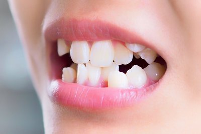 Gydytoja odontologė apžvelgė dantų tiesinimo būdus - Delfi sveikata