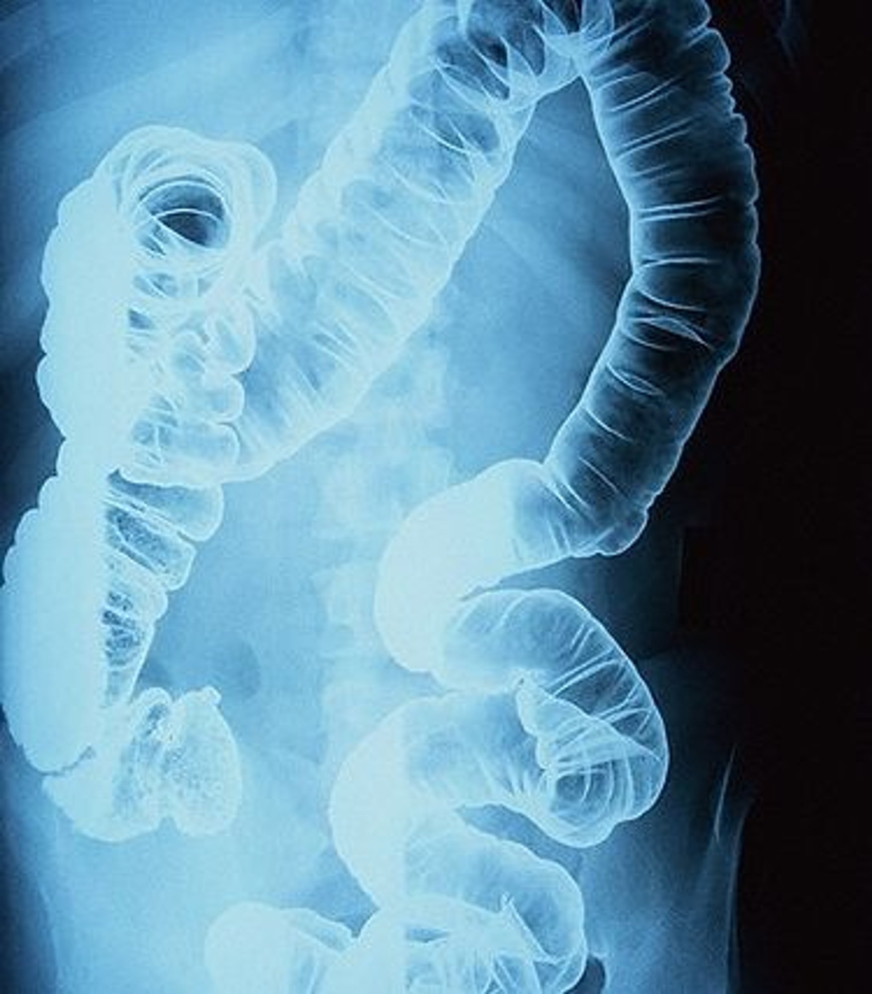 Žarnyno auglys – grėsmė ir jauniems - Delfi sveikata