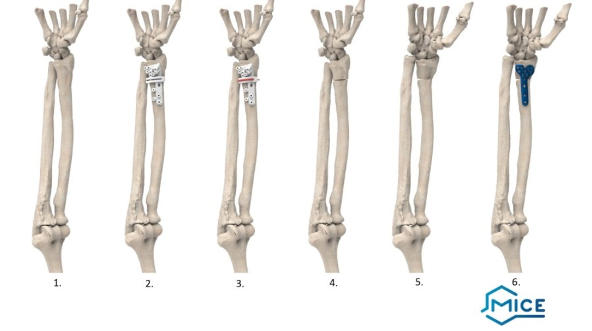 Išskirtinė operacija Lietuvoje: 3D spausdintuvas panaudotas rankos ...