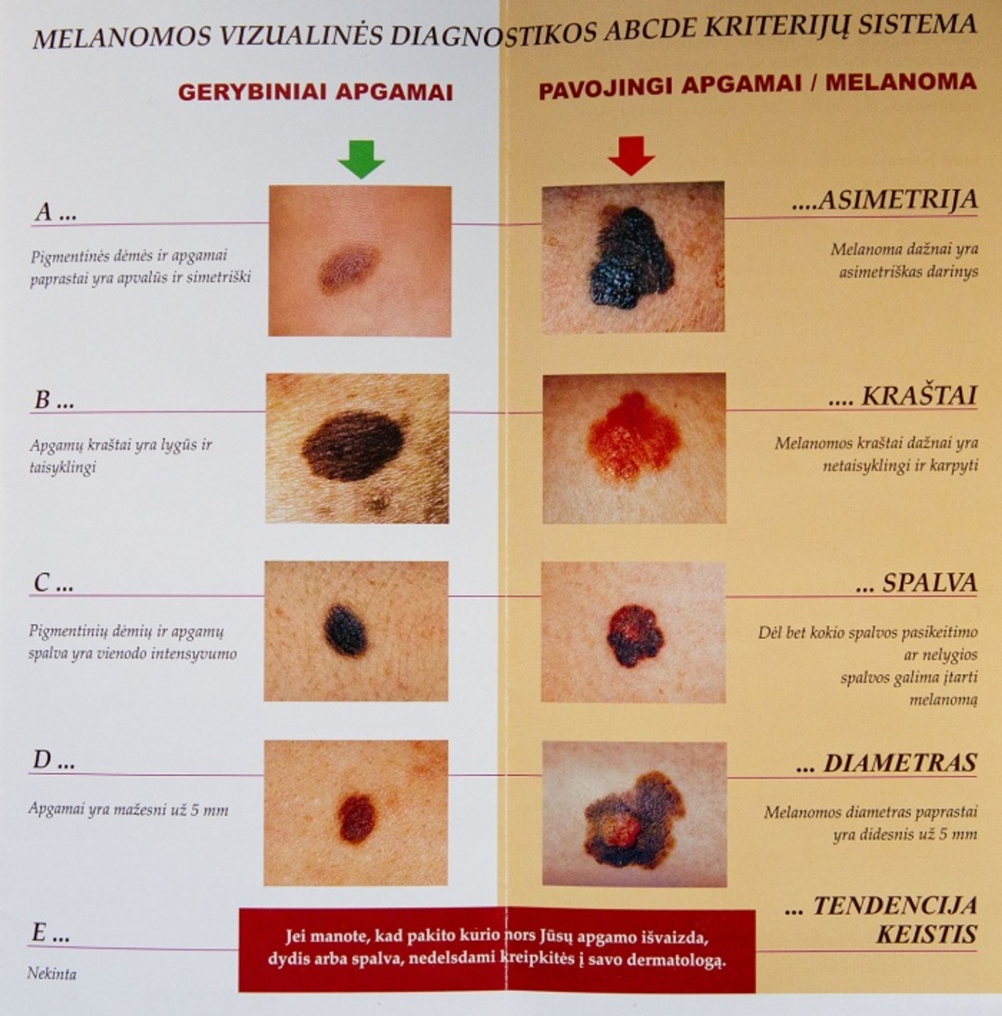 Saulės vonių belaukiant: kaip atpažinti odos vėžį? - Delfi sveikata