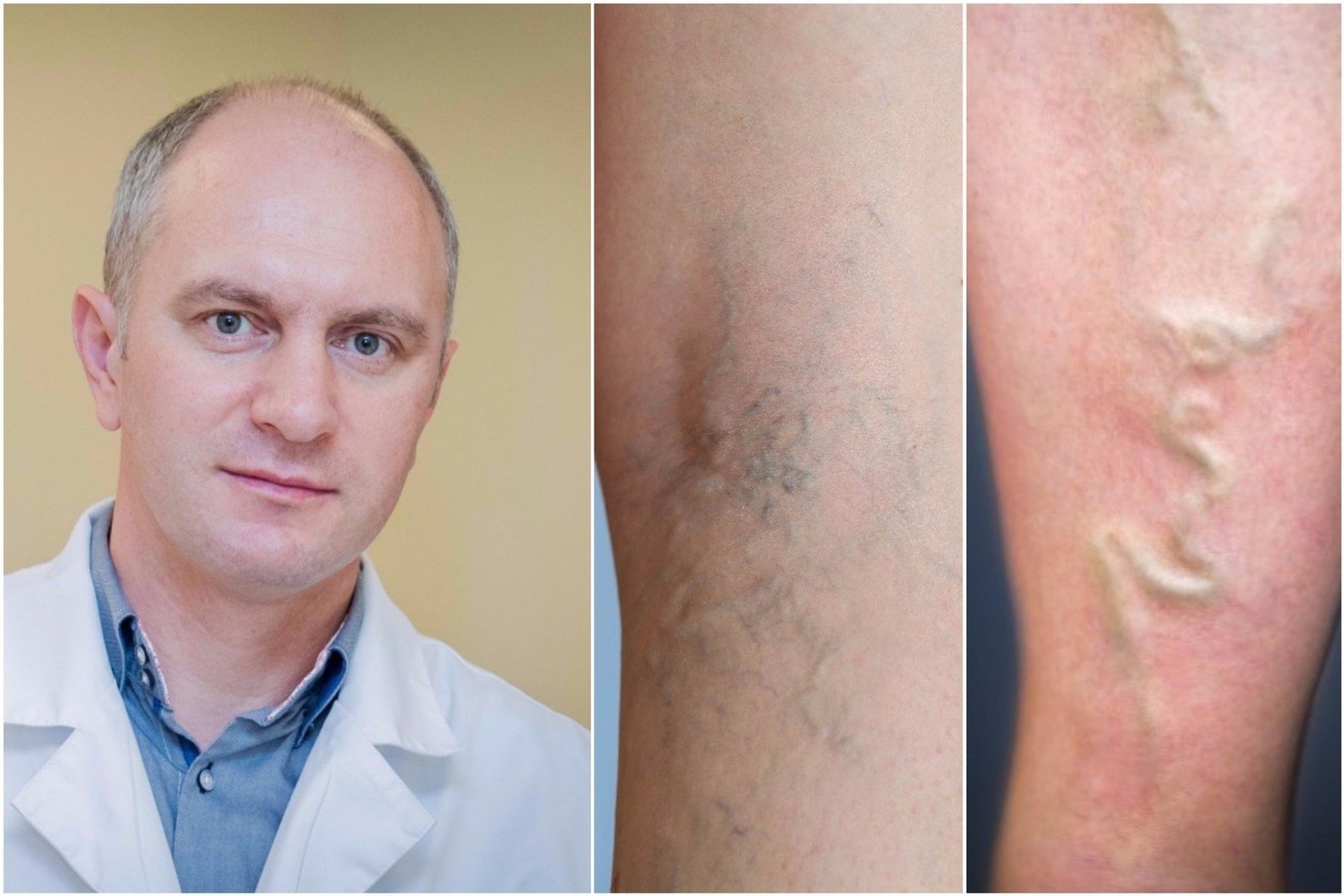 Pastebėti venų varikozę nesunku, tačiau ne visi susirūpina ...