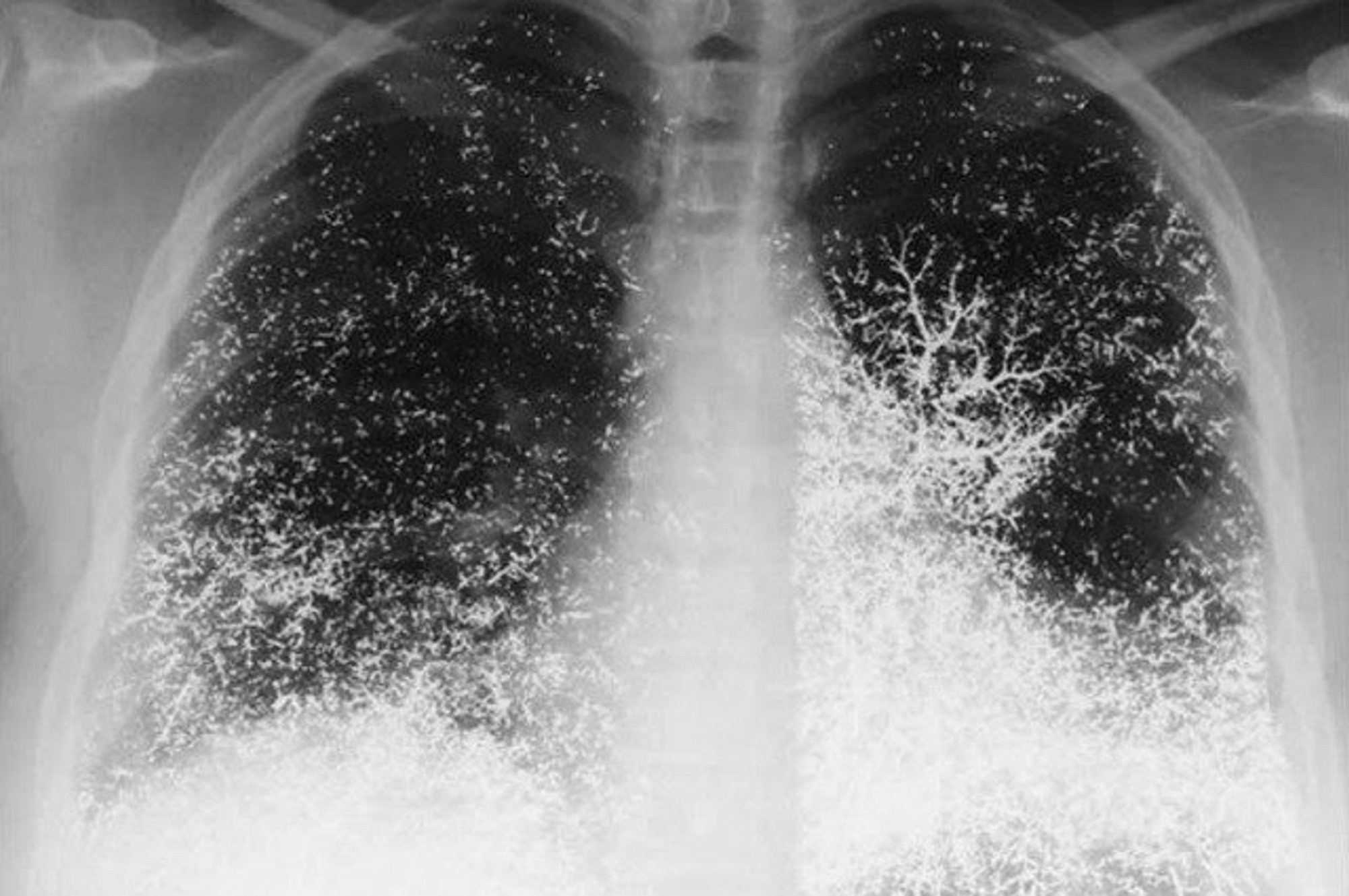 Gyvsidabrio pavojus: simptomai, į kuriuos negalima numoti ranka - Delfi ...